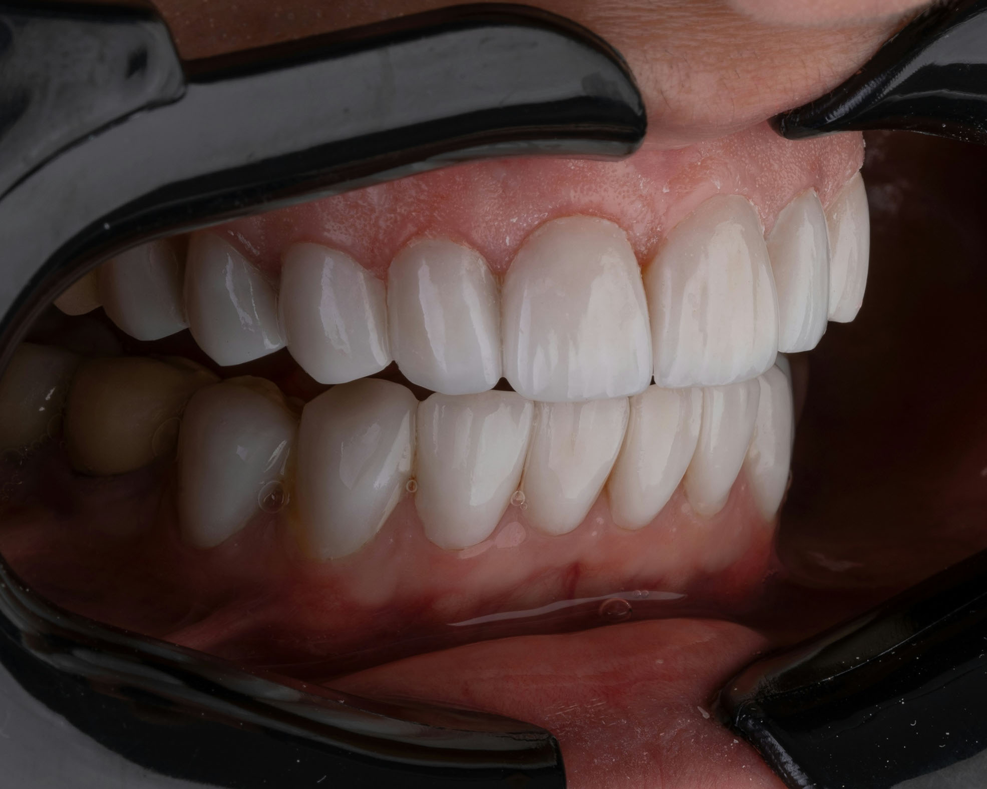 Placca dentale: cause e 9 modi per eliminarla subito