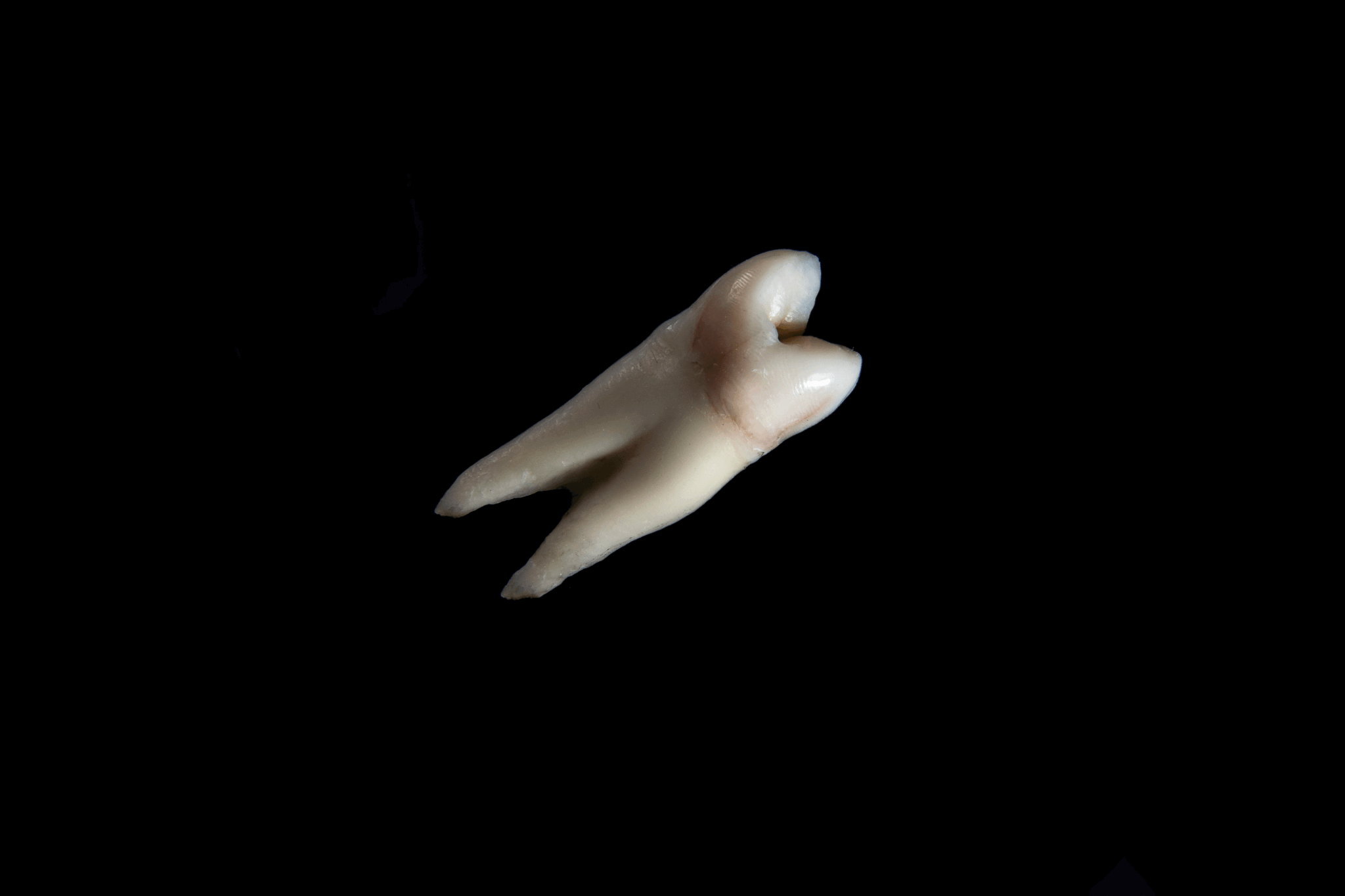 Frattura o dente spezzato alla radice? Sintomi & Rimedi